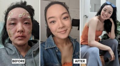 Aussie eczema-sufferer details her struggles with ‘elephant’ skin after ...